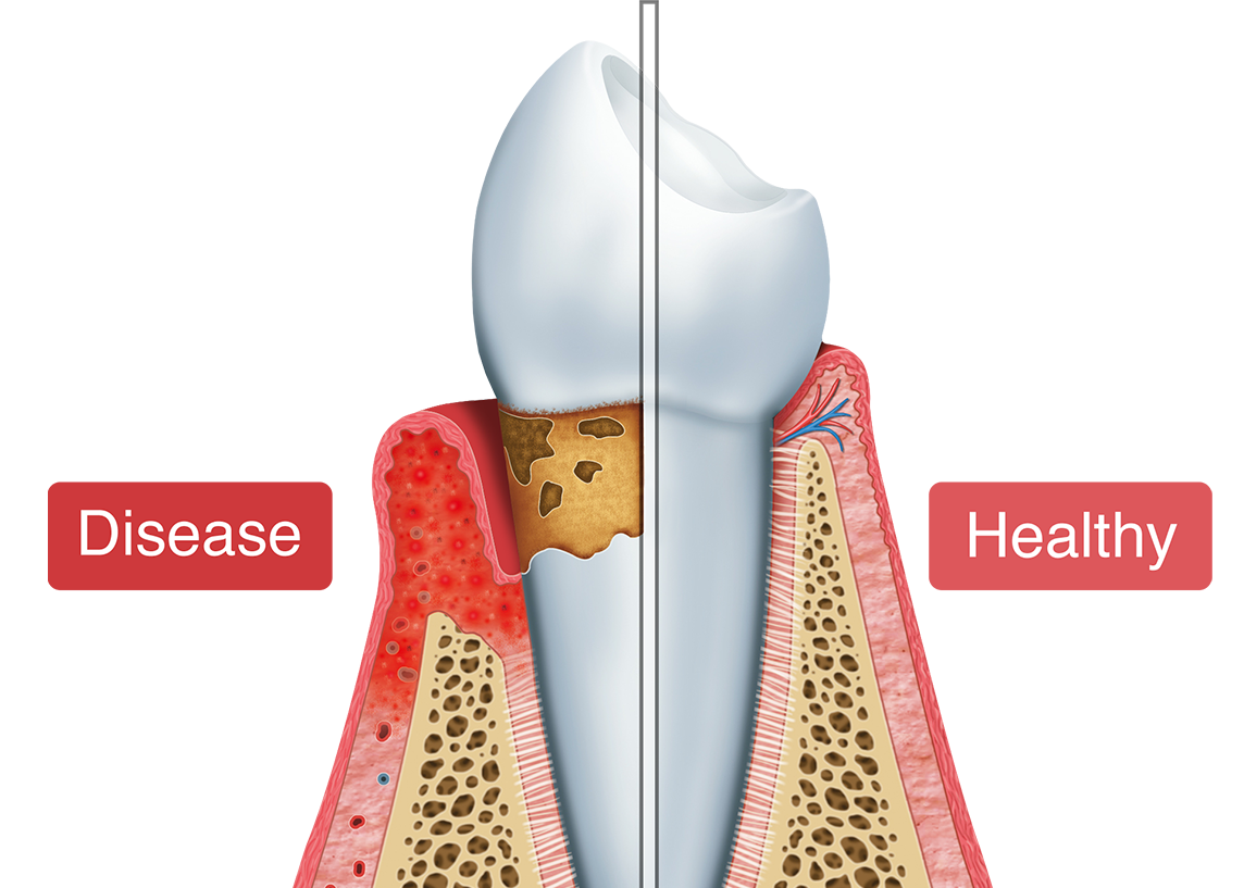 Periodontal Examination - Jeffrey S. Tatarin DDS