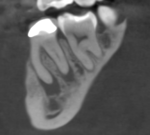 How are Dental Infections Removed? - Jeffrey S. Tatarin DDS